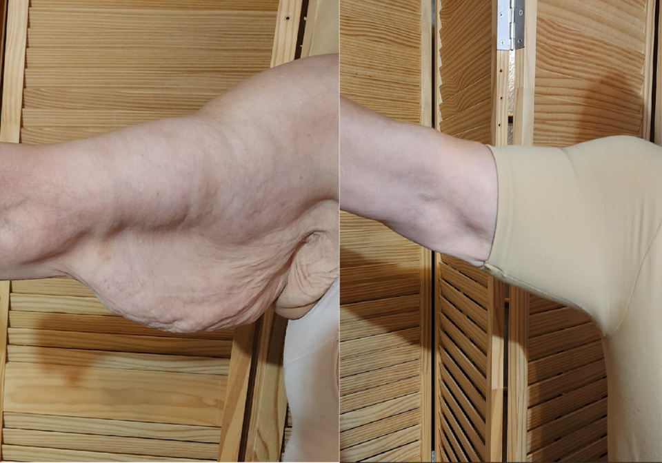 Upper Arm Support for Women | The Natural Posture